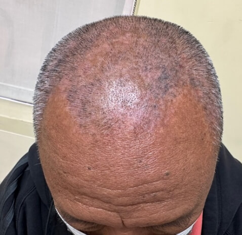 Plaque Psoriasis Results with ILUMYA® | ILUMYA® (tildrakizumab-asmn)