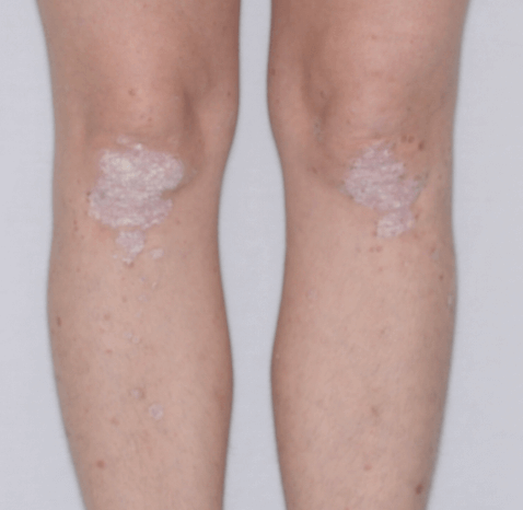 Plaque Psoriasis Results with ILUMYA® | ILUMYA® (tildrakizumab-asmn)