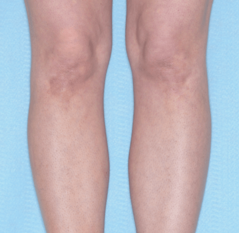 Plaque Psoriasis Results with ILUMYA® | ILUMYA® (tildrakizumab-asmn)