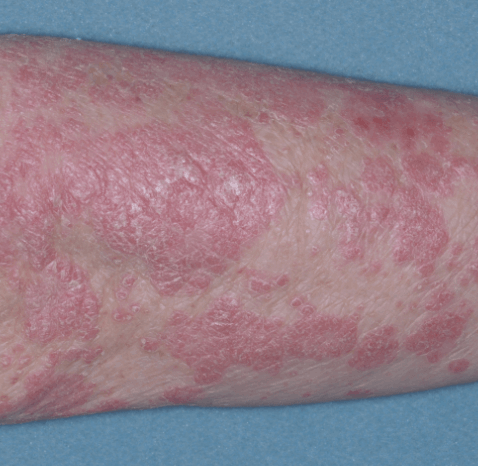 Plaque Psoriasis Results with ILUMYA® | ILUMYA® (tildrakizumab-asmn)