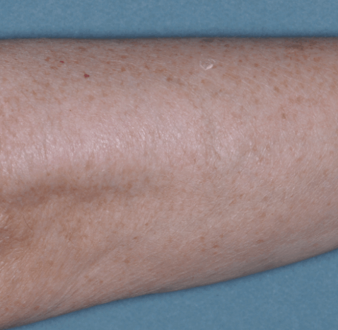 Plaque Psoriasis Results with ILUMYA® | ILUMYA® (tildrakizumab-asmn)